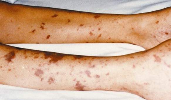 Meningitis – Symptoms, Treatment, Causes, Rash Pictures - HubPages
