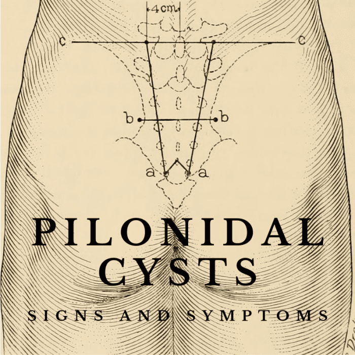 Painful Bump on Your Tailbone? Symptoms of a Pilonidal Cyst - HubPages