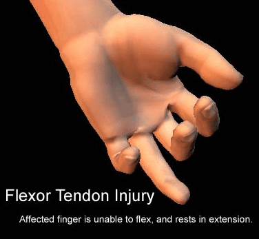 Tendon Injuries of the Hand - HubPages