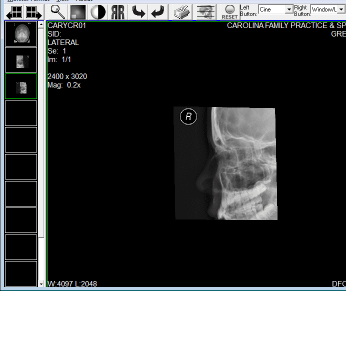 How To Tell If Your Child's Nose Is Broken - HubPages