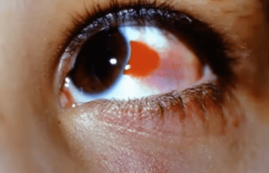 Burst blood vessel in eye – Symptoms, Causes, Treatment - HubPages