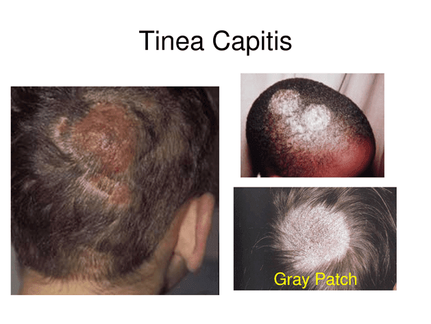 Dermatophytes that causes Cutaneous mycoses in humans and How to deal ...