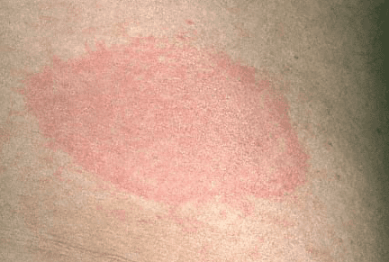 Lyme Disease: Rash Pictures, Test, Symptoms, Causes, Treatment - HubPages