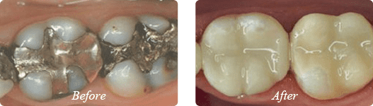 Dangers of Amalgam Mercury Fillings - HubPages