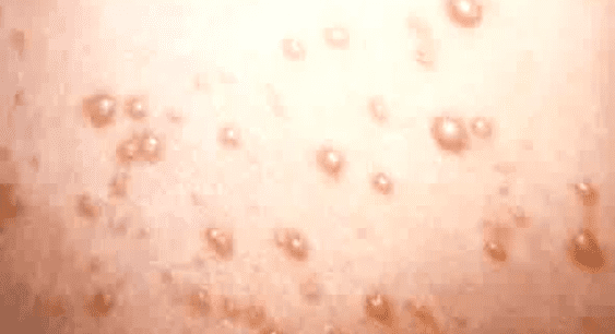 HIV Rash: Images, Symptoms, Location, and Treatment - HubPages