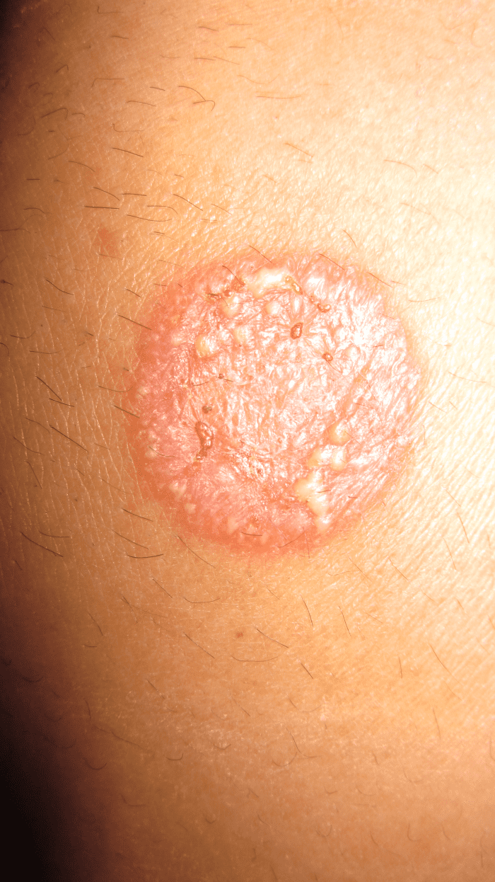 12 Causes of Itchy Legs (Including Photos and Remedies) - HubPages