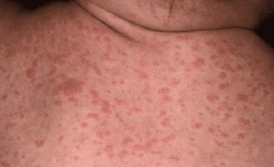 Lamictal Rash: Symptoms, Treatment, Images - HubPages