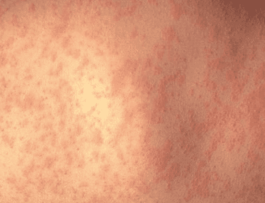 HIV Skin Rash - Images, Causes, Symptoms, Treatment - HubPages