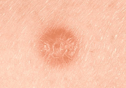 Dermatofibroma: Removal, Pictures, Symptoms, Treatment - HubPages