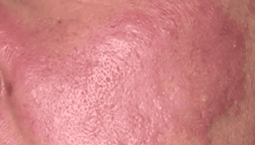 Lupus Rash – Pictures, Symptoms, Causes, Treatment - HubPages