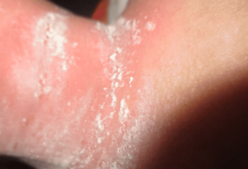 Intertrigo: Pictures, Rash, Symptoms, Causes, Treatment - HubPages