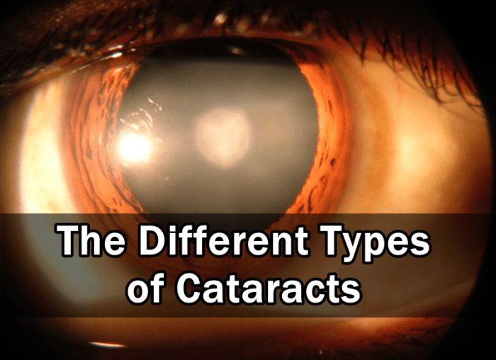 The Different Types of Cataracts - HubPages