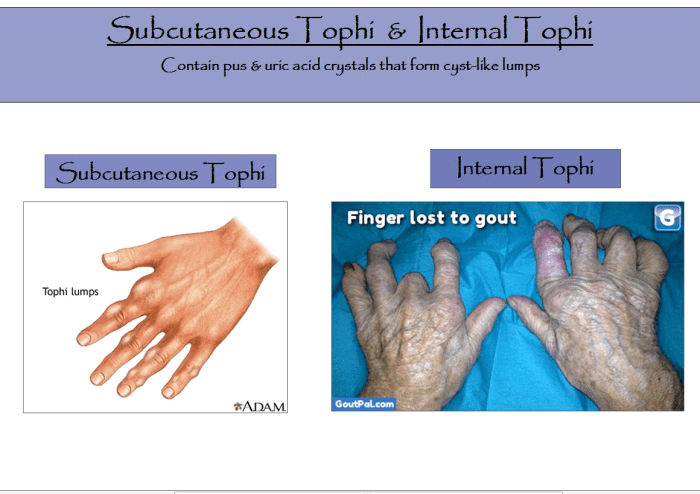 Everything You Ever Wanted to Know About Gout: Causes, Symptoms ...