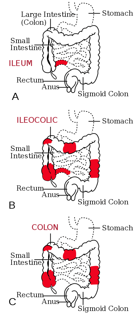 How I Manage My Crohn's Disease - HubPages