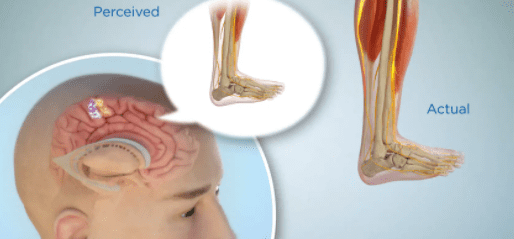 Amputation and Prosthetics - HubPages