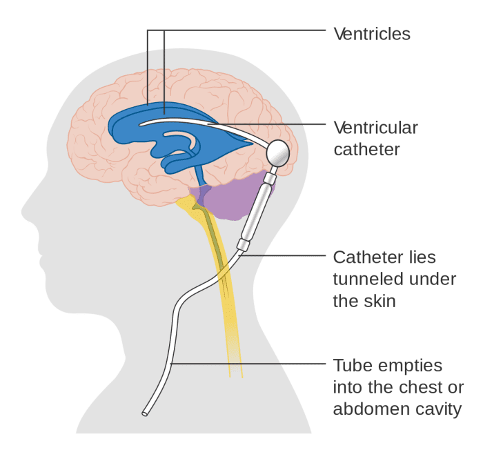 Hydrocephalus in Pediatrics - HubPages