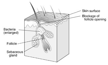 The Best Ways to Get Rid of Acne Scars - HubPages