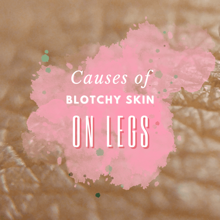 What Causes Blotchy Skin on Legs? - HubPages