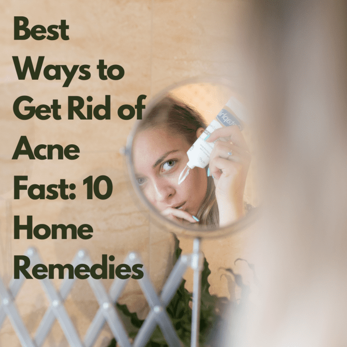 Best Ways to Get Rid of Acne Fast: 10 Home Remedies - HubPages