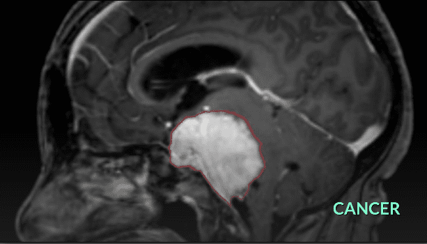 Panhypopituitarism - HubPages