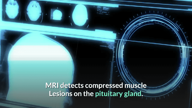 Panhypopituitarism - HubPages