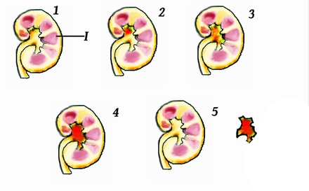 Facts About Staghorn Kidney Stones - HubPages