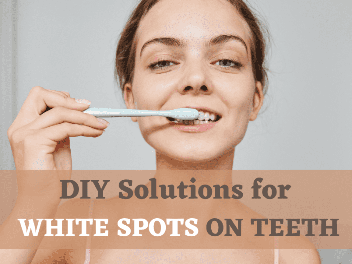 causes-of-white-spots-on-teeth-and-how-to-fix-them-at-home-youmemindbody