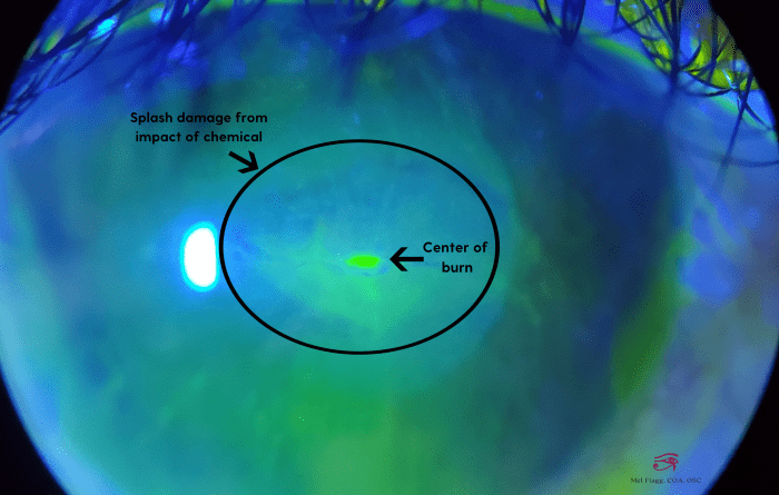 Emergency Eye Injury Treatment (Plus Easy Prevention Tips) - HubPages