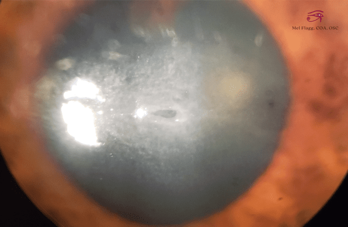 Emergency Eye Injury Treatment (Plus Easy Prevention Tips) - HubPages