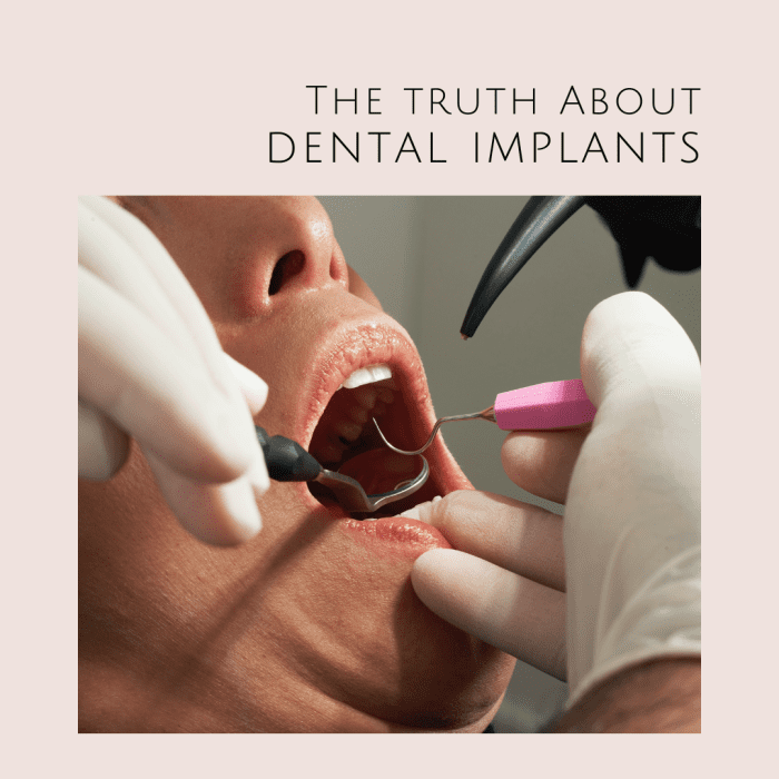 What Dentists Don't Tell You About Dental Implants - Patient's Lounge