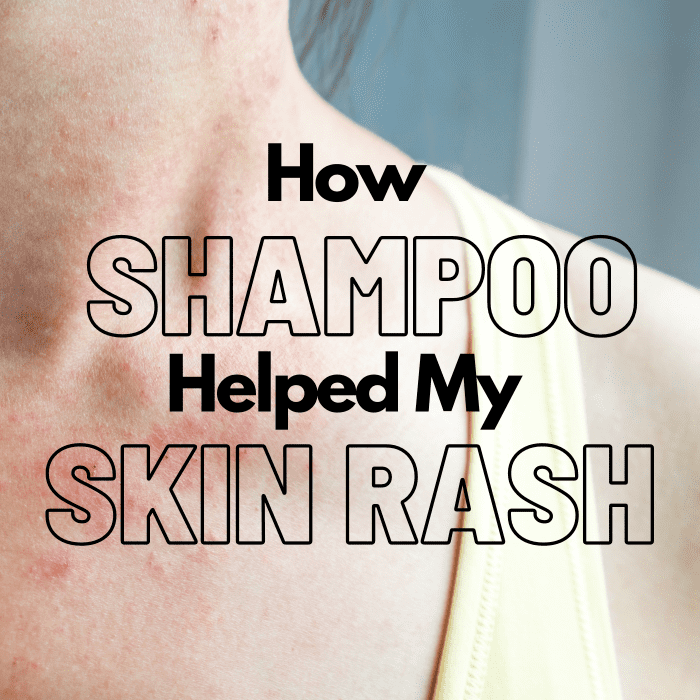 How to Treat Tinea Versicolor Inexpensively With Selsun Blue Shampoo ...
