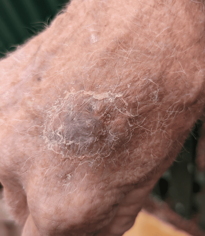 The Difference Between Boils and Carbuncles - HubPages