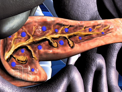 Type 1 Diabetes: Innovative Treatment, the Bionic Pancreas Brings Hope ...