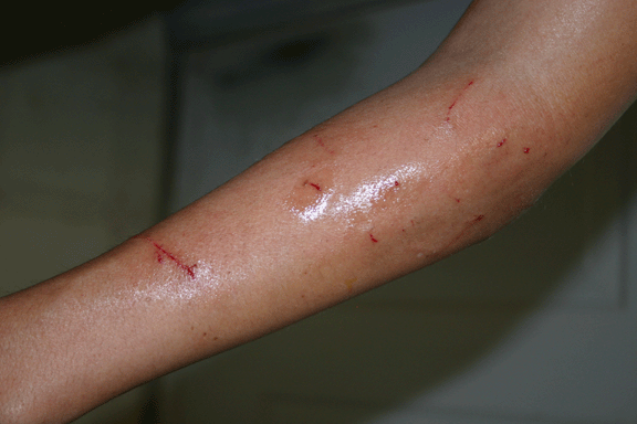 MRSA (staph infections) Warning Signs and Preventive Measures 3-10-14 ...