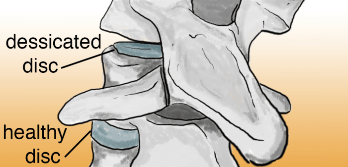 The Cause & Treatment of Desiccated Discs - HubPages