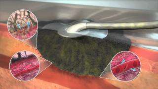 Wound Vac Therapy Information, Pictures and Cost - HubPages