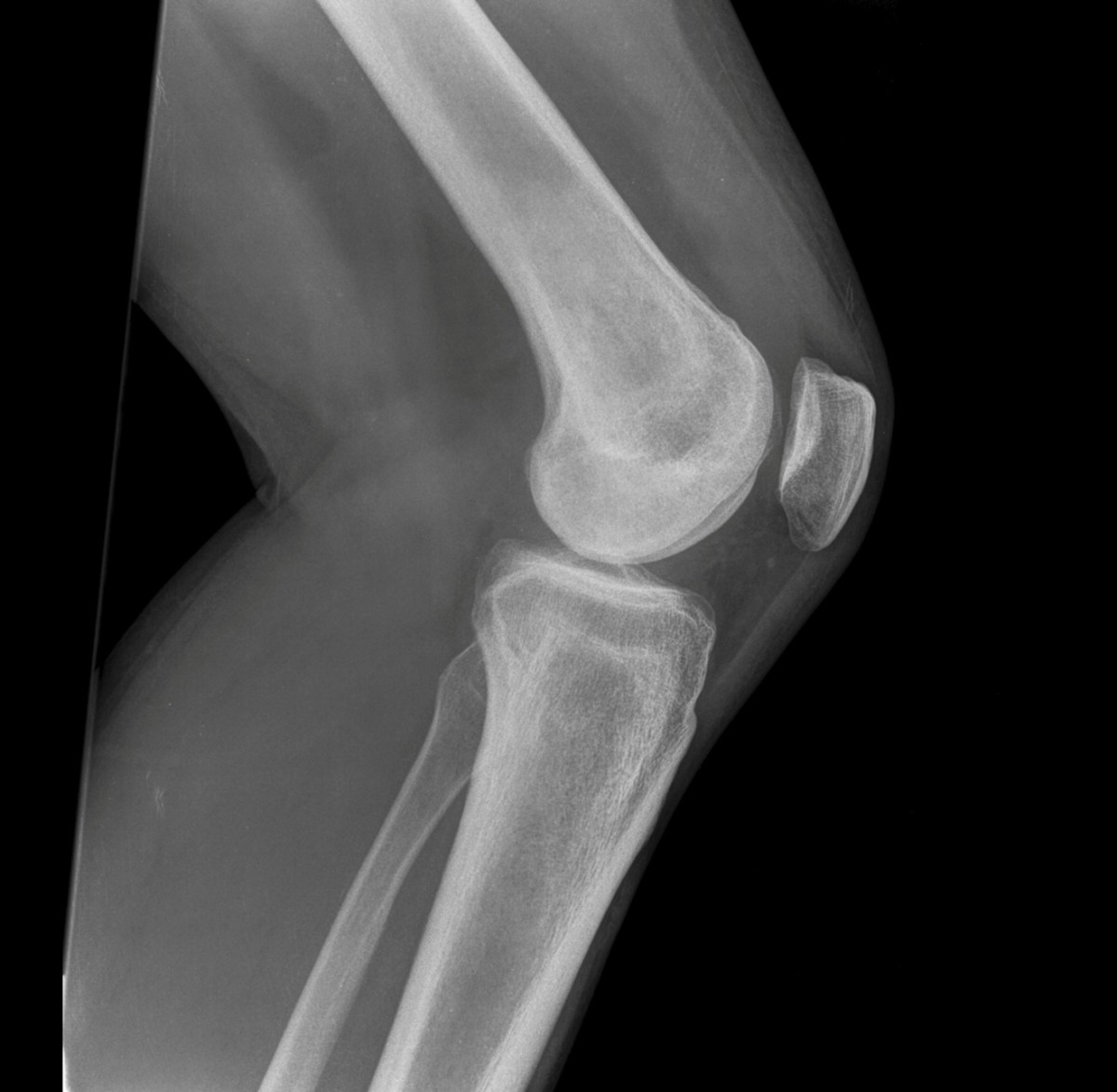 Anatomy Of The Knee Joint With Diagrams And X Ray Owlcation Anatomy Of The Knee Joint With Diagrams And X Ray Owlcation