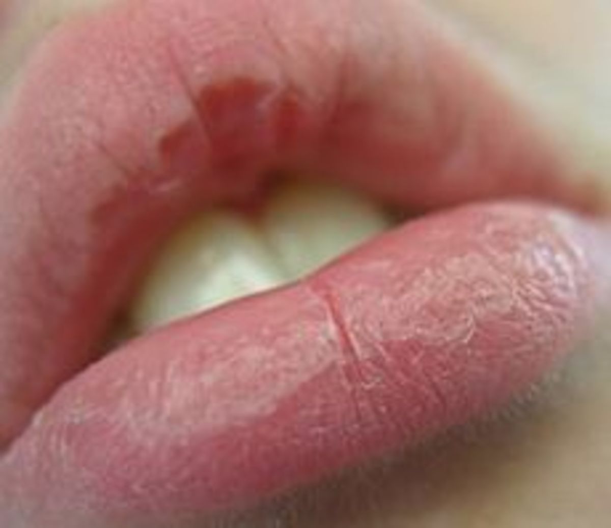 11 Natural Ways To Cure Chapped Cracked And Peeling Lips RemedyGrove