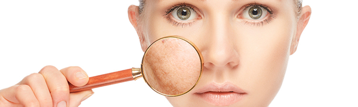 Rosacea: Conditions, Causes, Cautions, and Control - HubPages