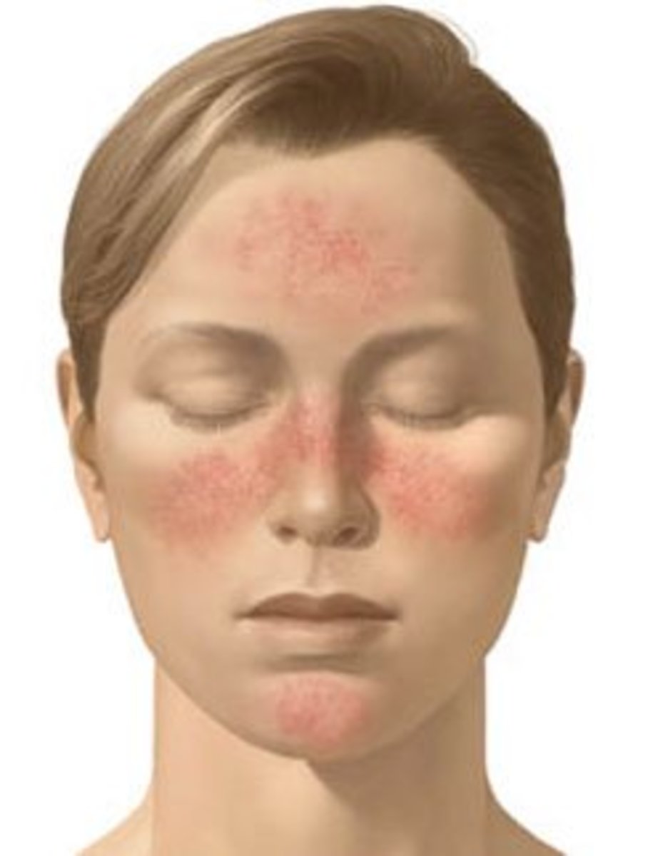 Rosacea: Conditions, Causes, Cautions, and Control - HubPages