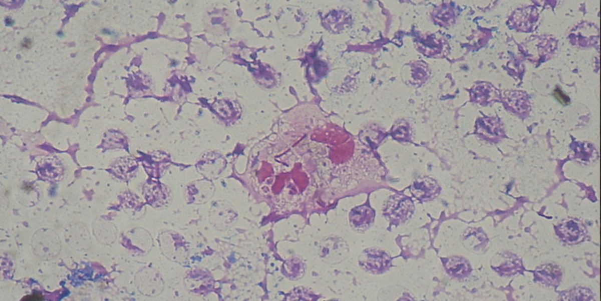 Snot and Mucus Decoded: The Meaning of Snot Colors - HubPages