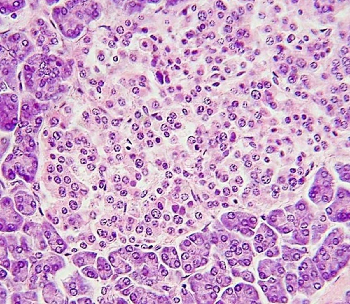 Pancreas Functions, Pancreatitis, and Type 1 and 2 Diabetes - HubPages