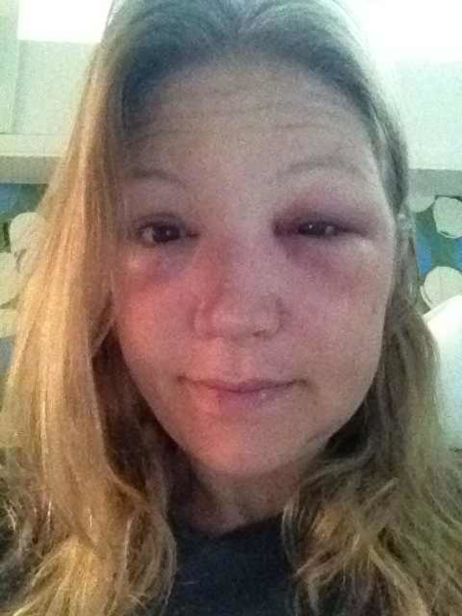 My Experience of a Bee Sting Near My Eye (With Photo Progression ...