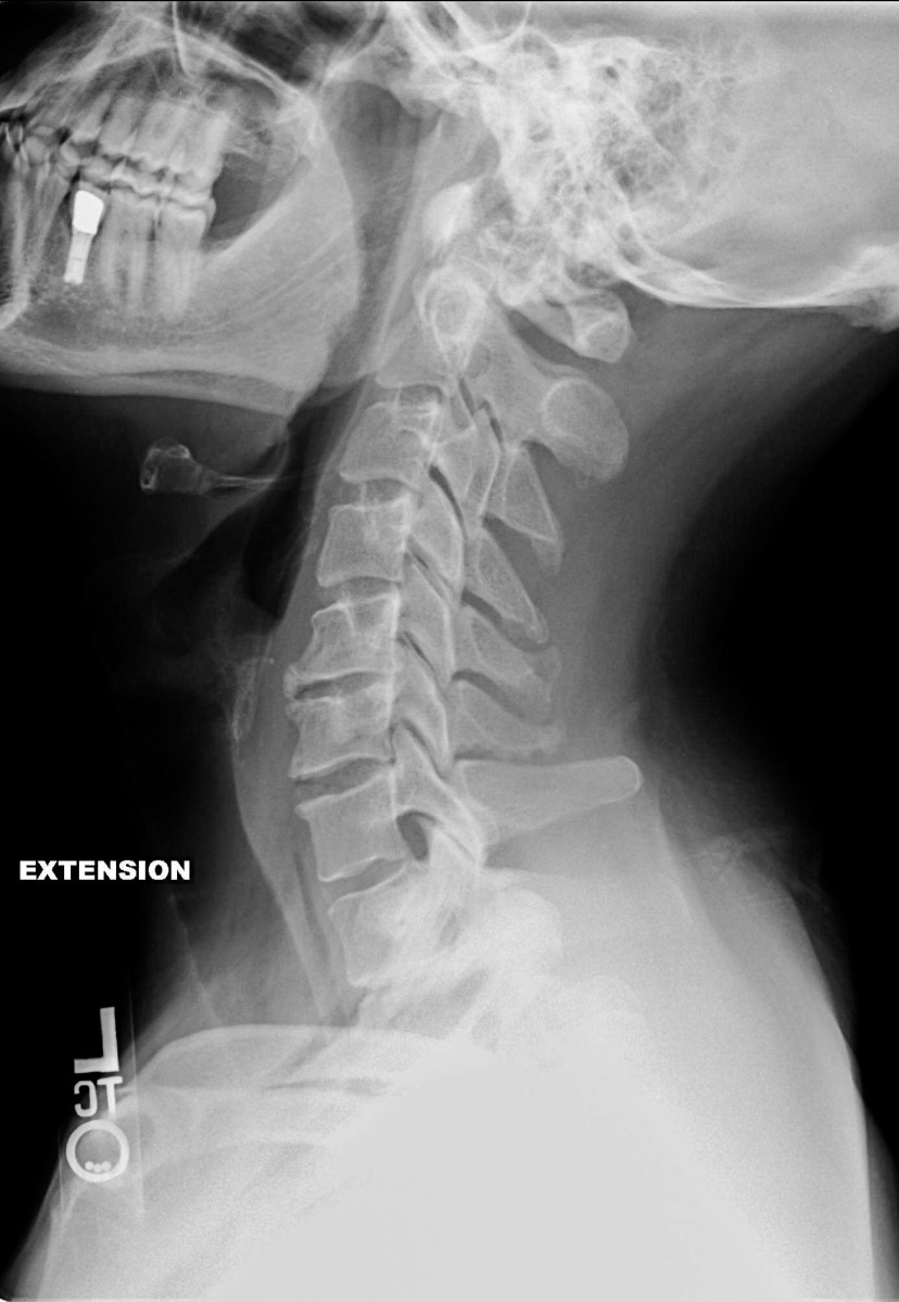 Bone Spur Facts, Effects, and Possible Treatments - HubPages