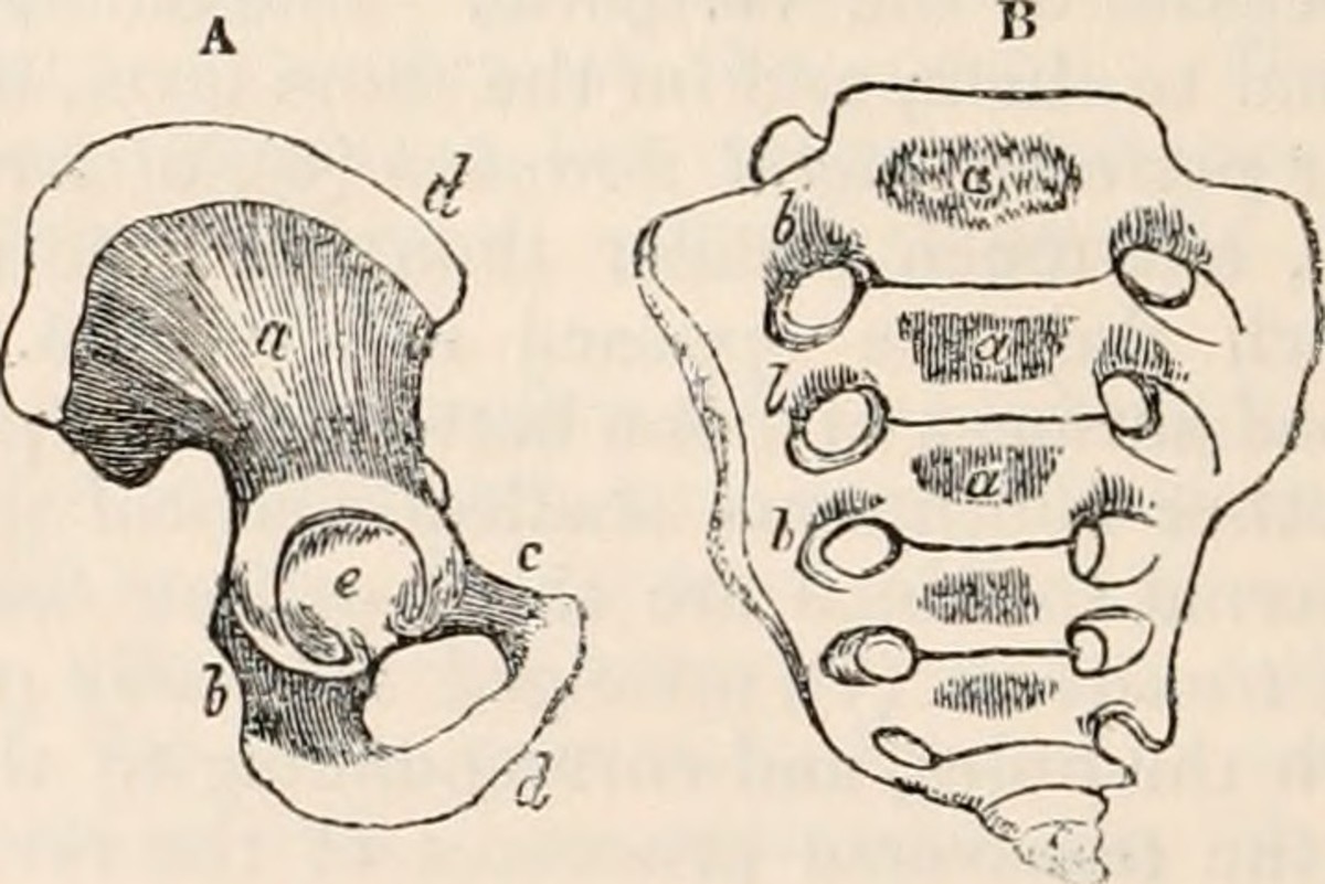 Diagram Of Pilonidal Cyst Diagram Of Pilonidal Cyst