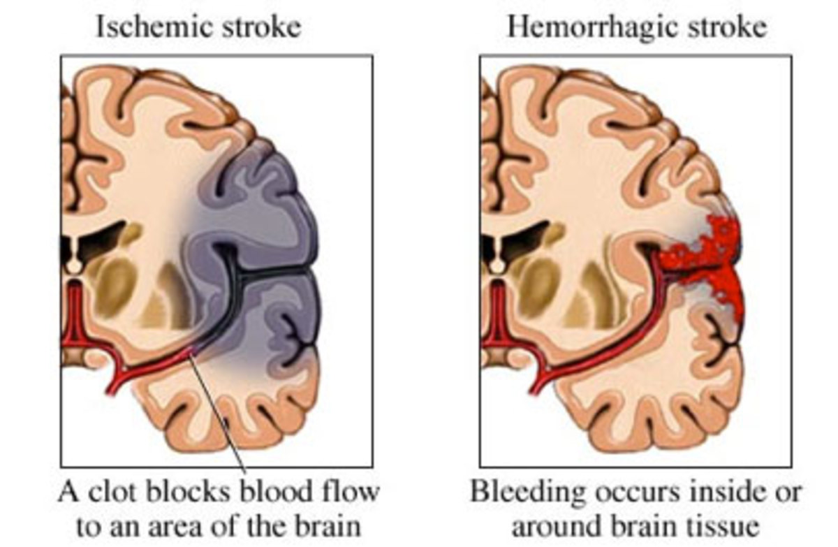 How to Recognize the Signs and Symptoms of a Stroke - HubPages