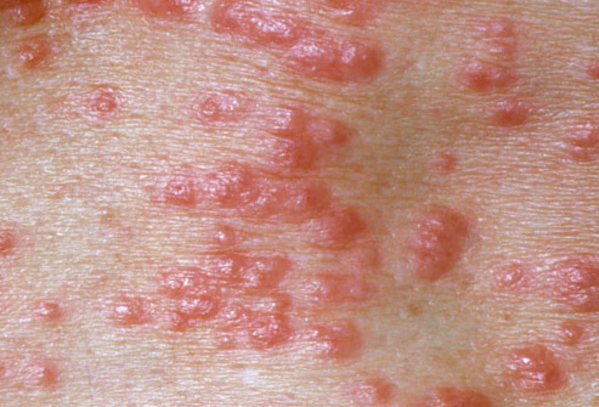 Scabies Symptoms, Treatment, Natural Remedies, and Prevention - RemedyGrove