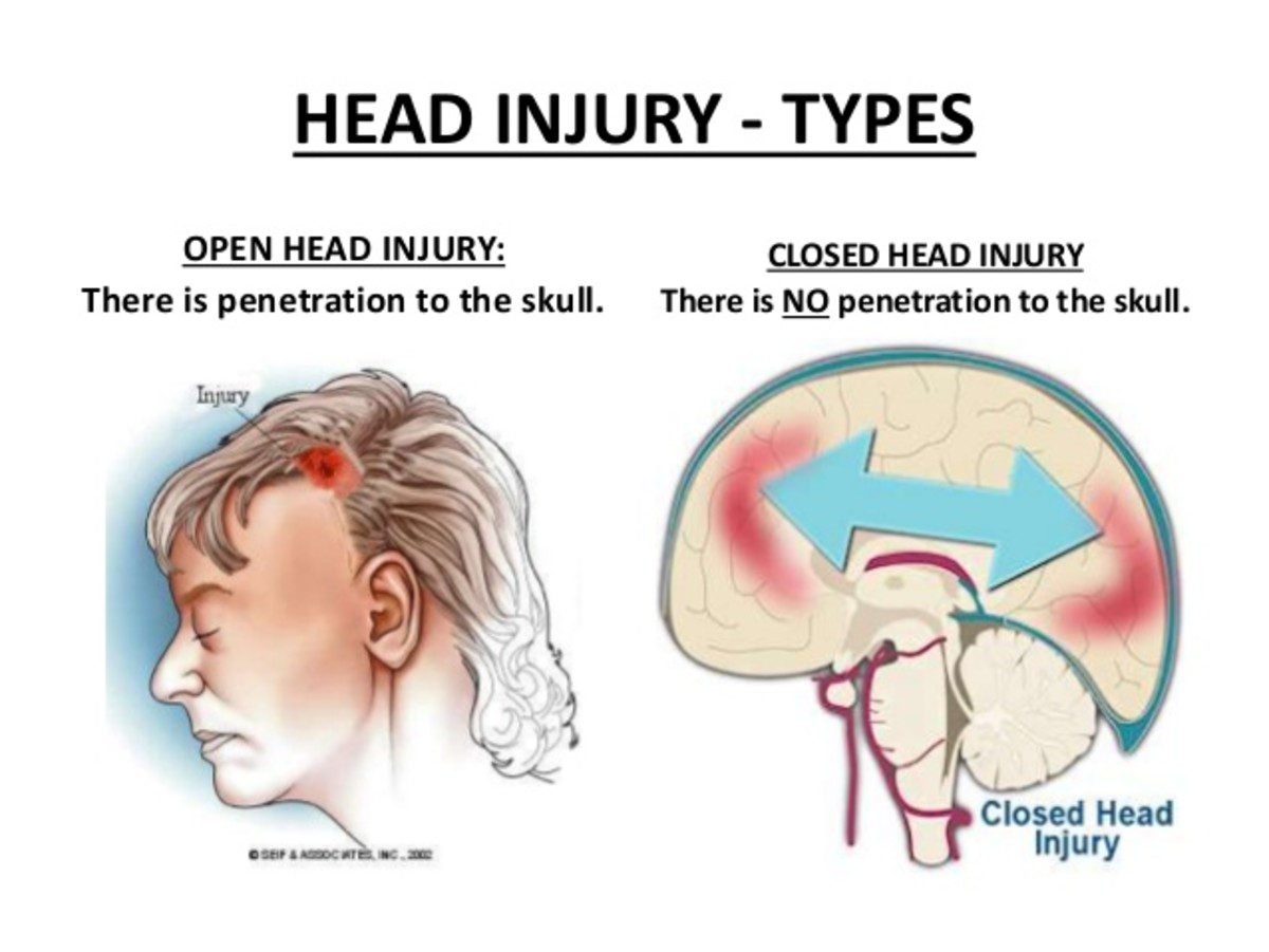 Moving Past the Guilt of Surviving Traumatic Brain Injury - Patient's ...