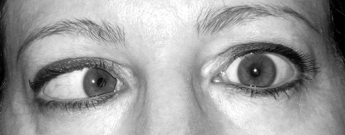 I Have Duane Syndrome, a Rare Eye Condition - Patient's Lounge