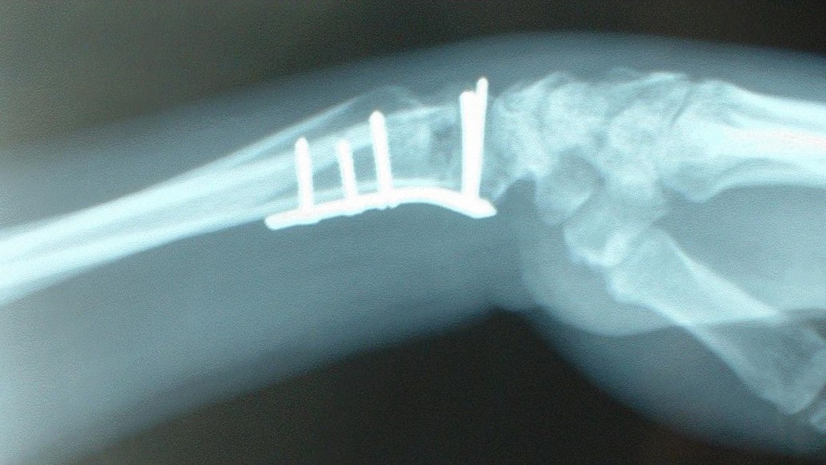 Recovering From Two Broken Wrists: My Story - Patient's Lounge